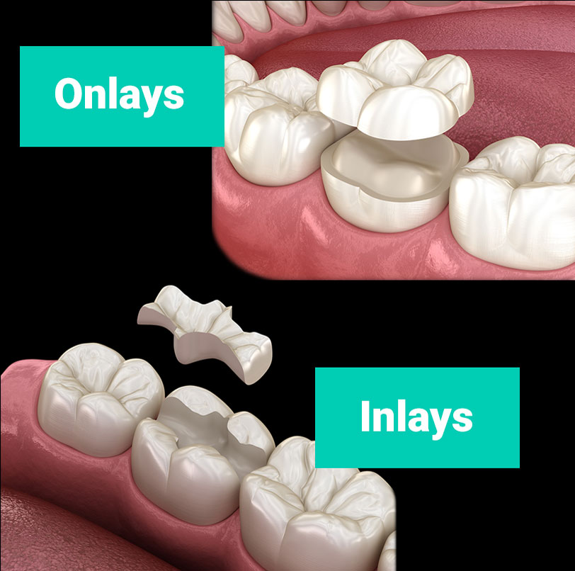 Inlays and Onlays | Dentist in Las Vegas, NV 89129